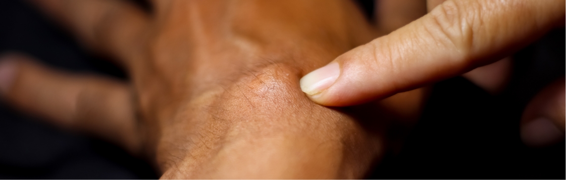 Cyst Removal | Safe & Effective Treatments for Cysts