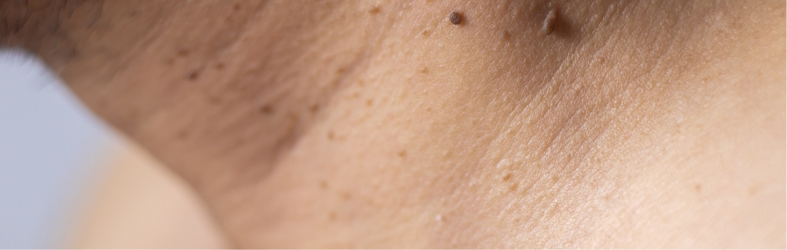 Skin Tag Removal in Boca Raton, FL | Rendon Center